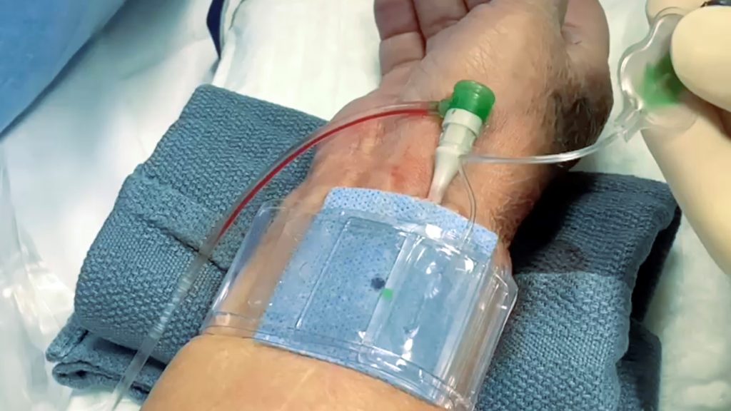 SoftSeal®-STFR Overview – Chitogen