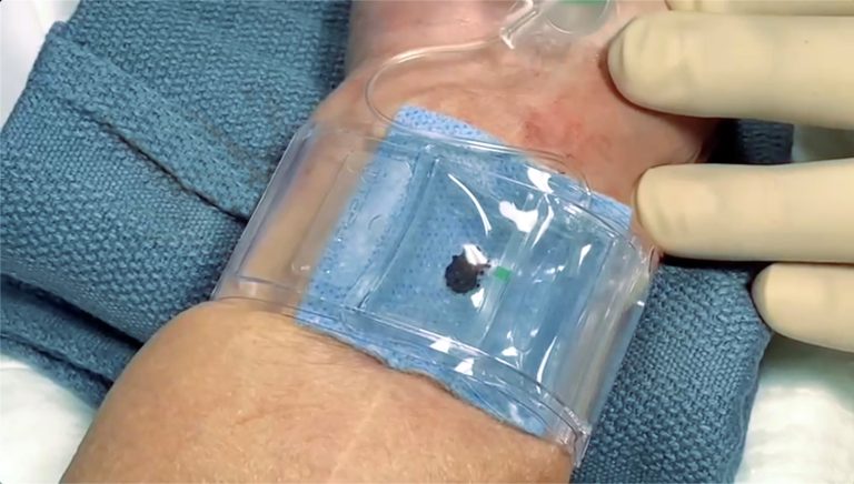 SoftSeal®-STFR Overview – Chitogen